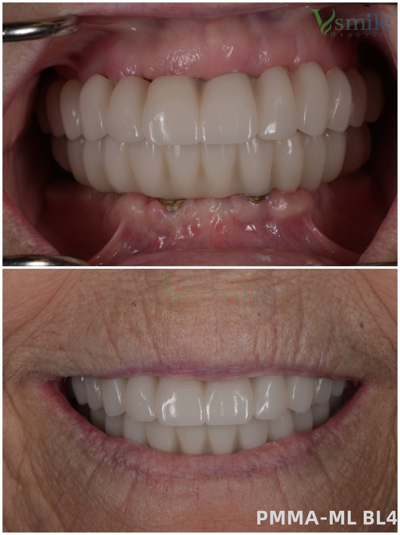 multilayer PMMA disc , Dental PMMA material , Multilayered dental ...