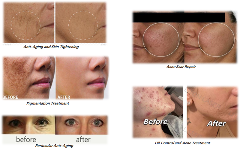 1550nm Erbium laser and the 1927nm Thulium laser-dual wavelength Mid Infrared Fractional Laser ...