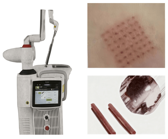 Ablative vs Non-Ablative Fractional Lasers: Expert Comparison Guide