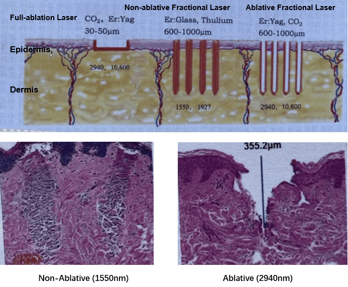 What Is Fractional Laser? | A Complete Guide to Understanding its ...