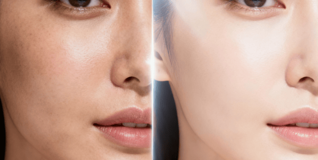 What is Q Switch Laser Treatment